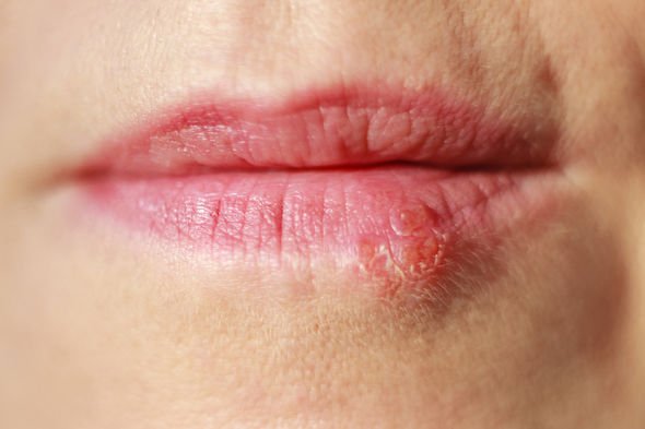 What vitamin deficiency causes cold sores?