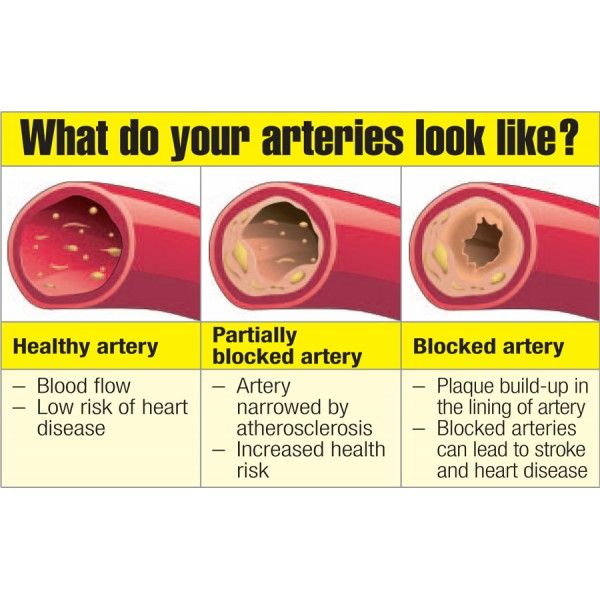 What will dissolve plaque in arteries?