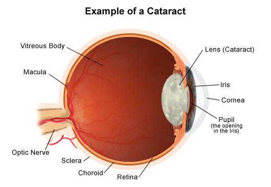 Where does cataract grow?