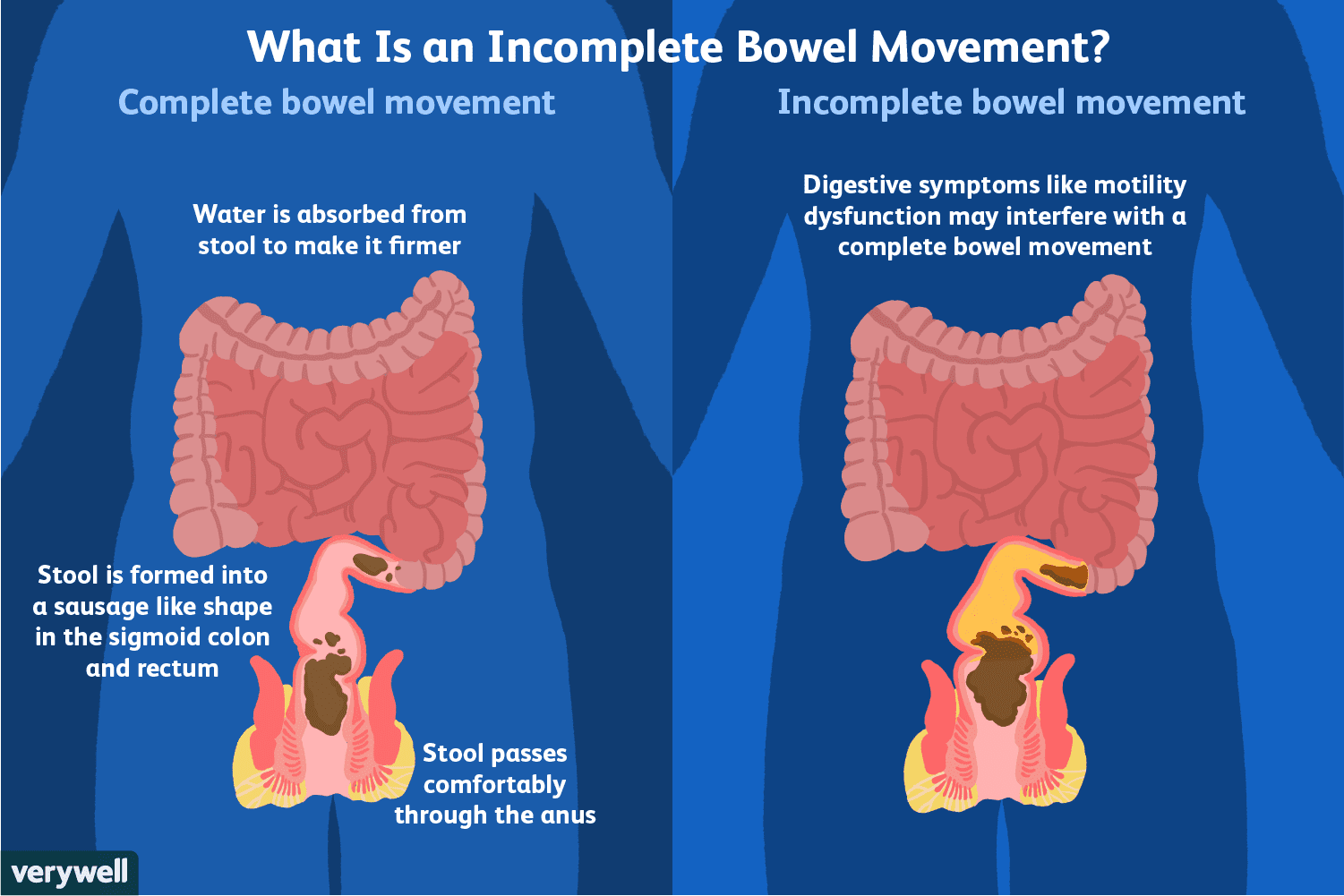 Why can't I fully empty my bowels?