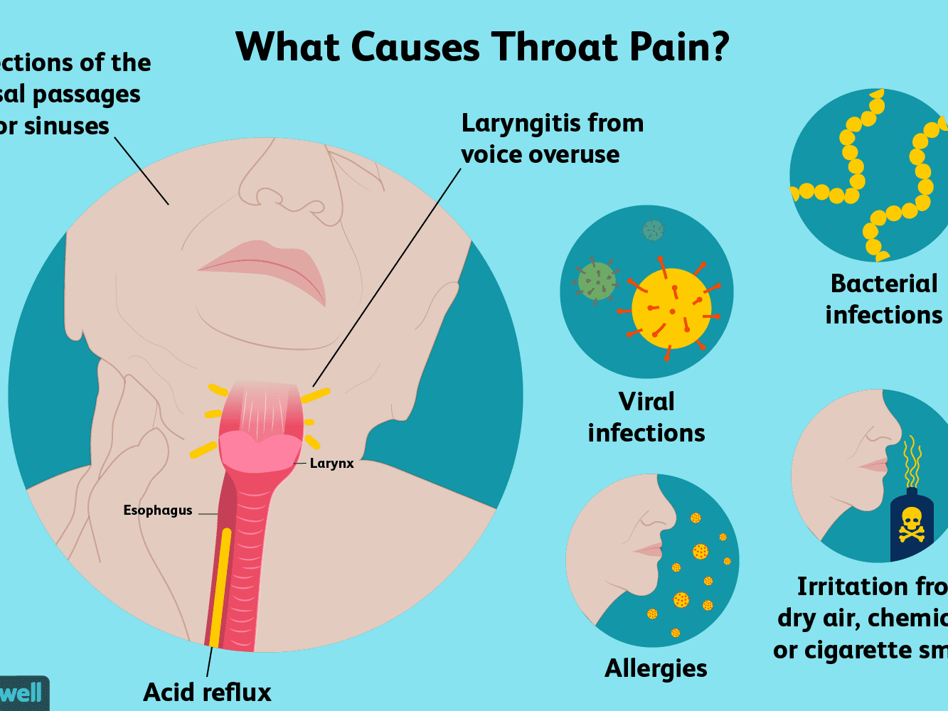 Why do I get sore throat after eating?