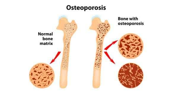 Why does lack of calcium cause osteoporosis?