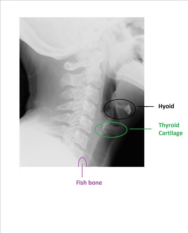 Will a fish bone eventually dissolve in your throat?