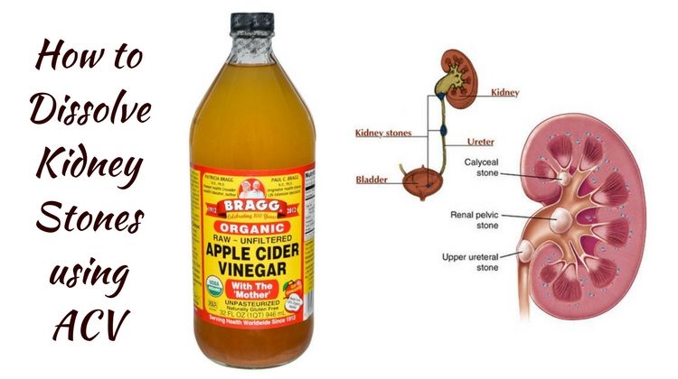 Will apple cider vinegar dissolve bladder stones?